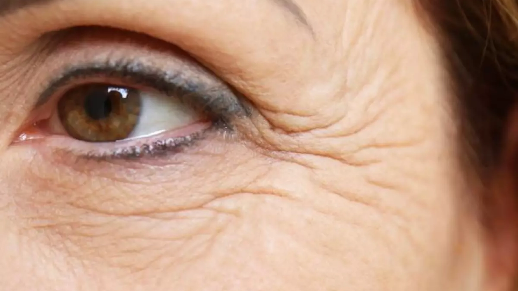 Conheça os principais tipos de rugas e os tratamentos mais eficazes ...